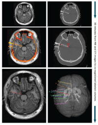 iEEG Imaging and Analysis - Persyst