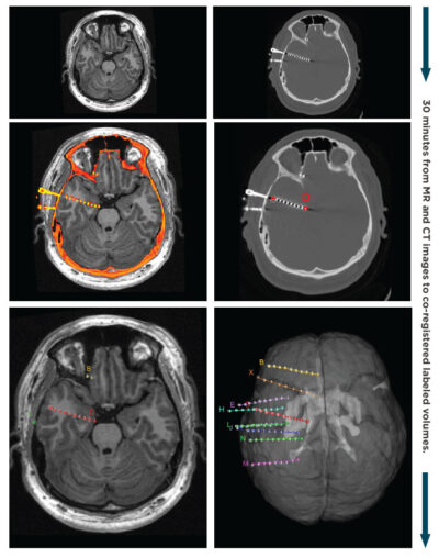 iEEG Imaging and Analysis - Persyst